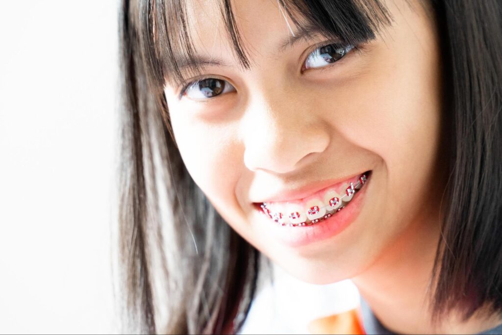 Dale estilo a tu sonrisa con estas ideas de colores para brackets