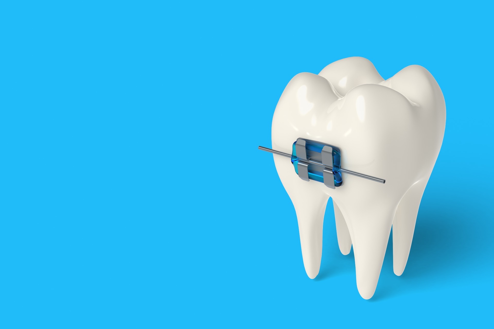 Conoce los diferentes tipos de brackets que existen